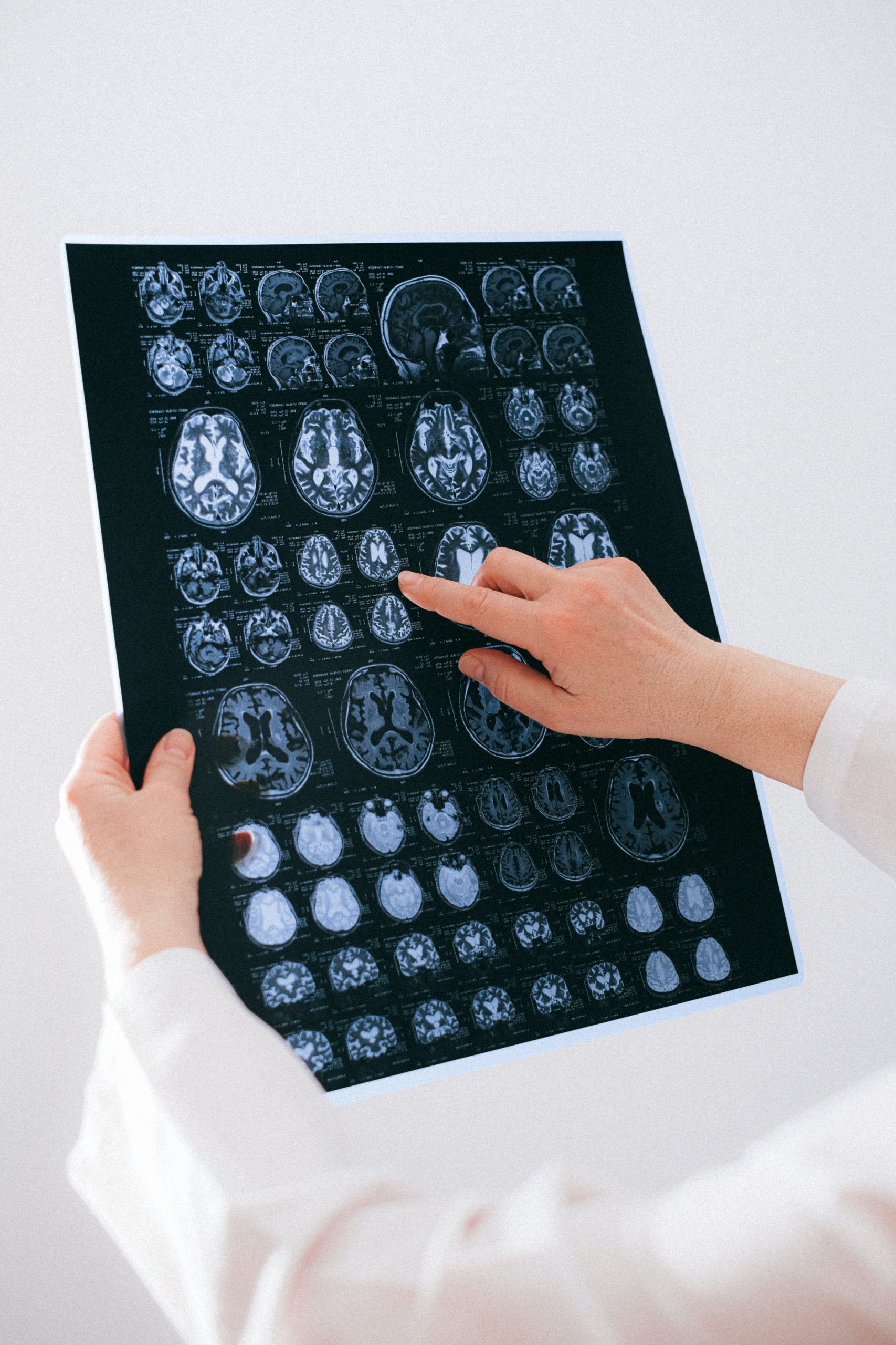 Como identificar os sintomas da Esclerose Múltipla? – Pro Exame